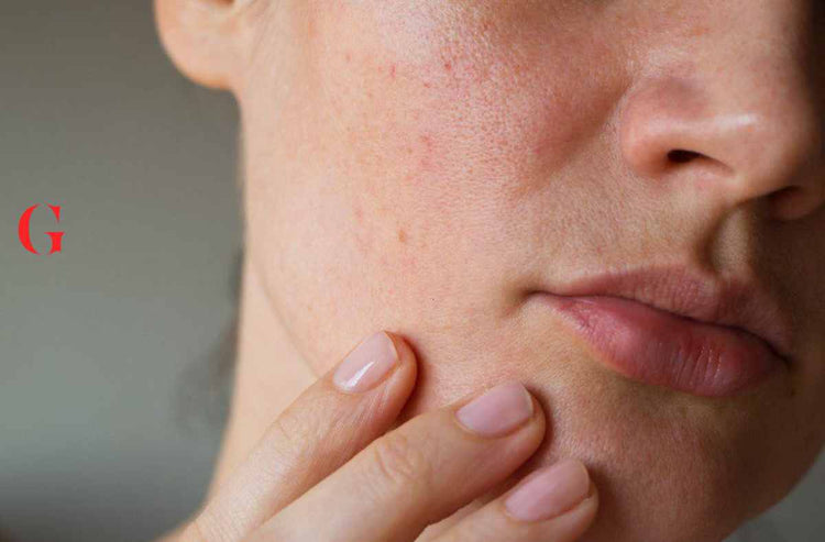 Wajib Tahu, Ini 5 Urutan Skincare Kulit Sensitif yang Benar! – Glow Mates