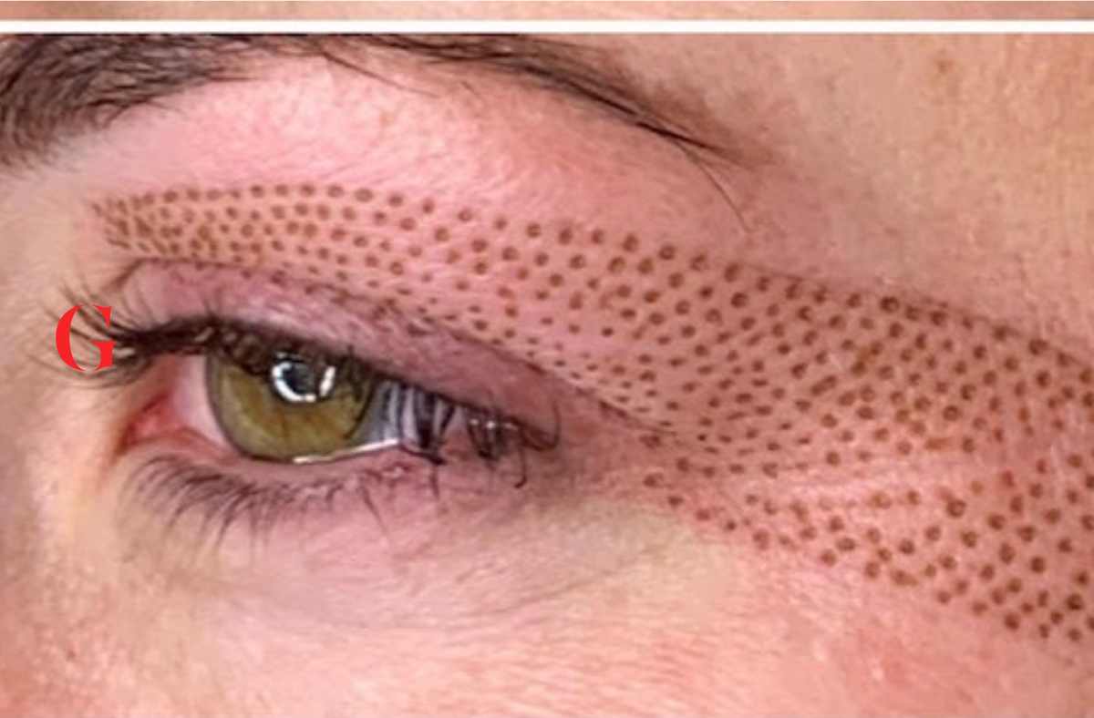 Berbagai Hal yang Perlu Diketahui Tentang Plasma Lift – Glow Mates