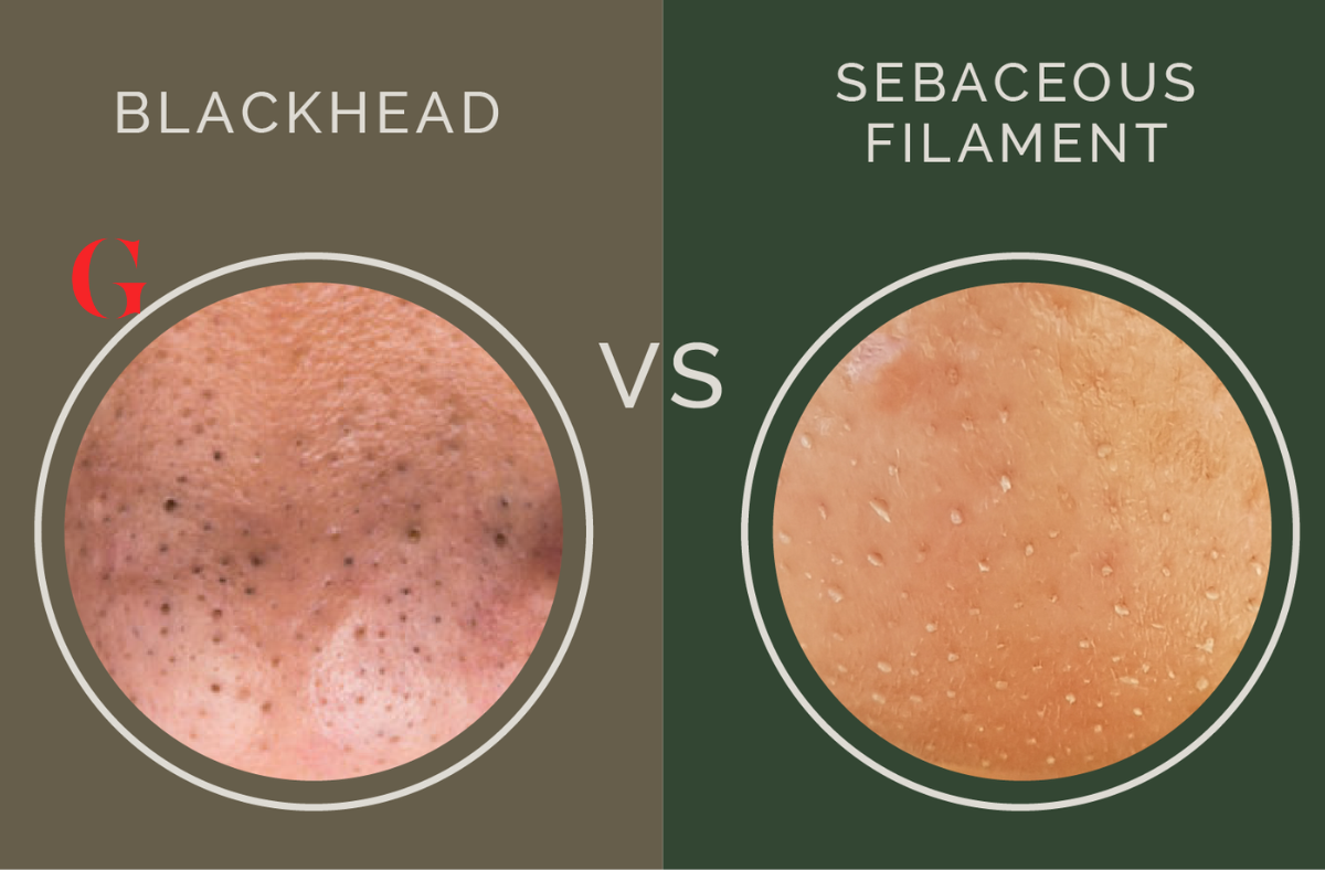 Mencerahkan Bintik Hitam di Hidung: Cara Mengatasi dan Mencegah Sebace ...